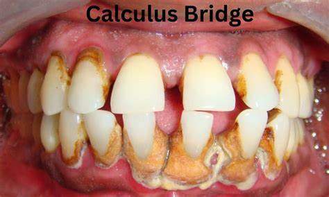 Calculus Bridge: Definition, Applications, and Significance - Leedsjournal
